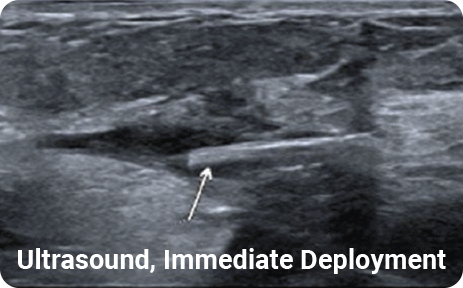 Breast Biopsy Markers | Mammotome® Markers